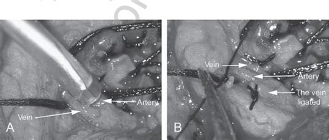 Figure 2 From Subinguinal Microsurgical Varicocelectomy With