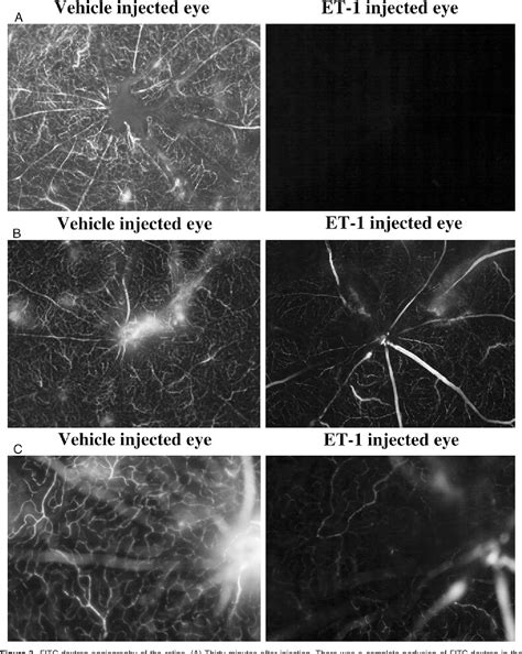 Figure 3 From A Model Of Retinal Ischemia Reperfusion Injury In Rats By Figure 3 From A Model Of Retinal Ischemia Reperfusion Injury In Rats By