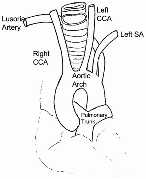 Cerebral Arteries