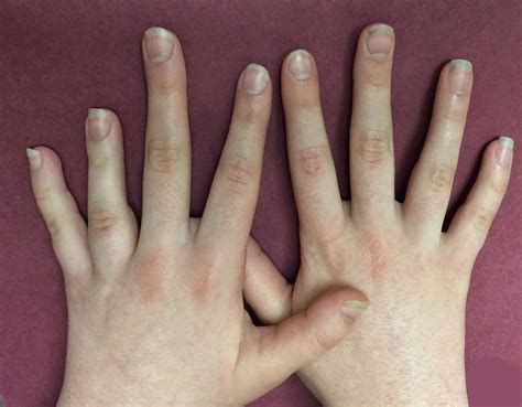 The Short 4th Metacarpal Congenital Hand And Arm Differences Washington University In St Louis