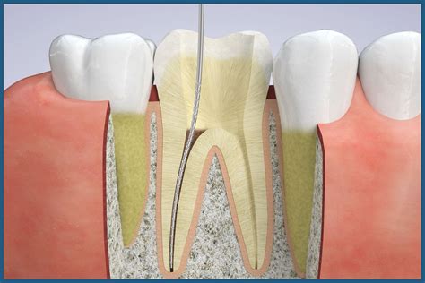 Root Canals Narrow River Endodontics