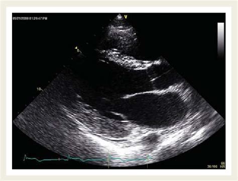 Figure 2 From Acute Myocarditis Can Novel Echocardiographic Techniques Assist With Diagnosis