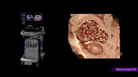 Voluson™ Expert 18 Ge Healthcare United States Voluson™ Expert 18 Ge Healthcare United States