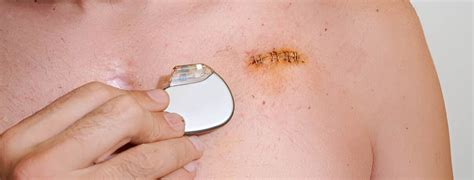 10 Things You Need To Know When Living With A Pacemaker Kauvery Hospital