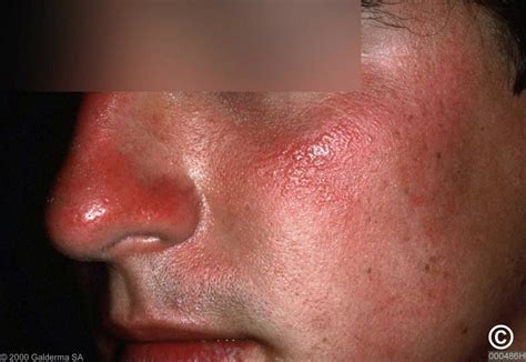 Understanding Photosensitivity Causes Treatment And Prevention Tips