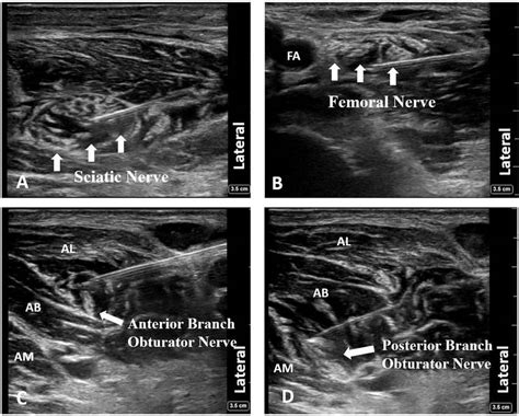Femoral And Sciatic Nerve