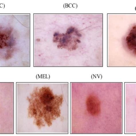 Sample Skin Lesion Types Collected From The Ham10000 Dataset 20