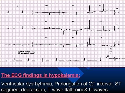 Hypokalemia Introduction Potassium Is One Of The Bodys