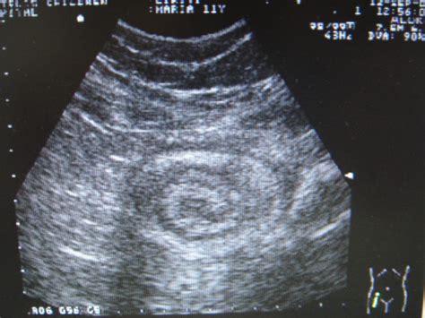 Us Of The Lower Right Abdomen Suggesting Intussusception Of The Appendix Download Scientific