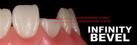 Preparing Teeth For Class Iv Direct Composite Restoration Spear Education