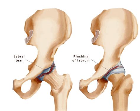 What Are Labral Tears David Slattery