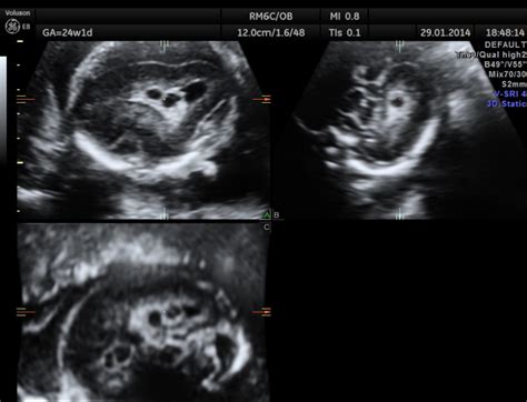 Choroid Plexus Cyst Looking Through A Transducer