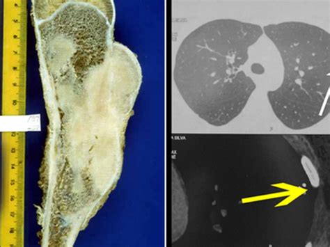 Osteosarcoma With Pulmonary Metastasis Oncosurgery