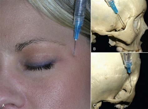 Zygomaticotemporal Nerve Block