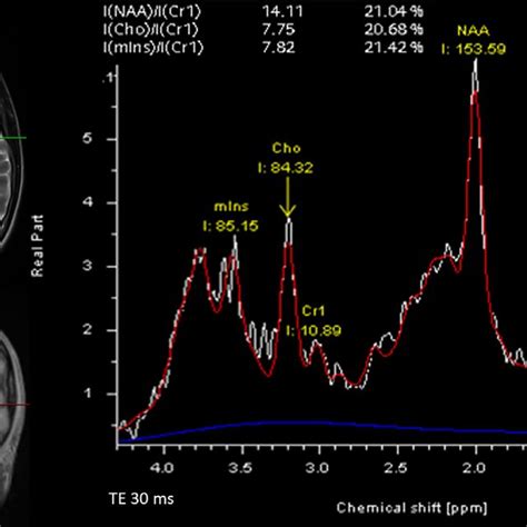 Mr Spectroscopy At Echo Time Of 30 Ms With Voxel Placed Over The