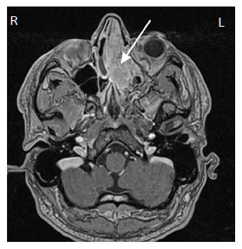 Risk Factors Of Recurrence And Malignant Transformation Of Sinonasal