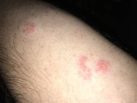 Skin Bumps On Arms