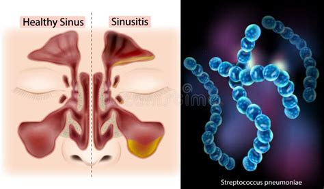 Comparison Of Healthy Sinus And Sinusitis With Streptococcus Pneumoniae