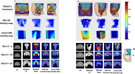 figure 6 from toxicity prediction in pelvic radiotherapy using multiple instance learning and