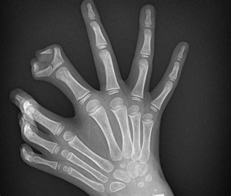 人魚症候群（人魚のような奇形）の赤ちゃんのレントゲン写真… ポッカキットポッカキット