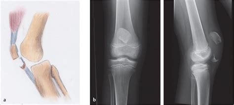 38 Patella Fractures Musculoskeletal Key