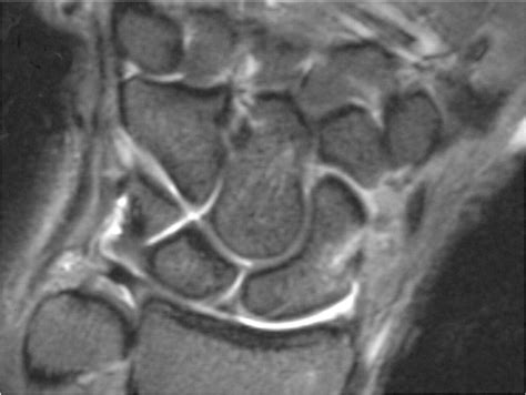 Scaphoid Bone Bruising Probably Not The Precursor Of Asymptomatic Non
