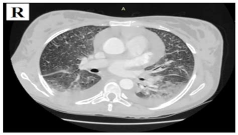 Axial Contrast Enhanced Computed Tomography Scan Of Chest Indicating