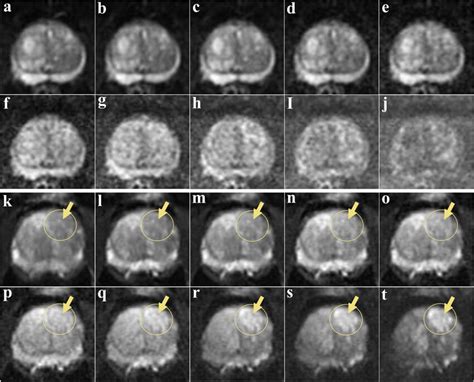 Intravoxel Incoherent Motion Diffusion Weighted Imaging Ivim Dwi At Download Scientific
