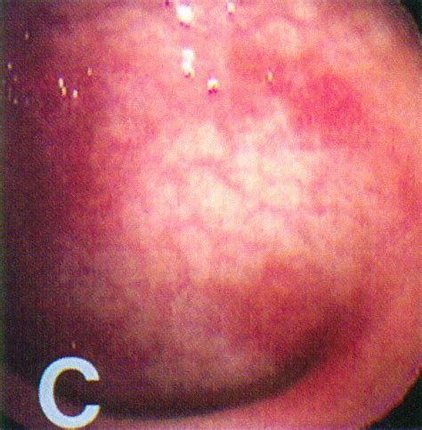 Patchiness Of Mucosal Inflammation In Treated Ulcerative Colitis A