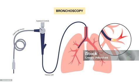 Bronchoscopy Procedure Concept Stock Illustration Download Image Now