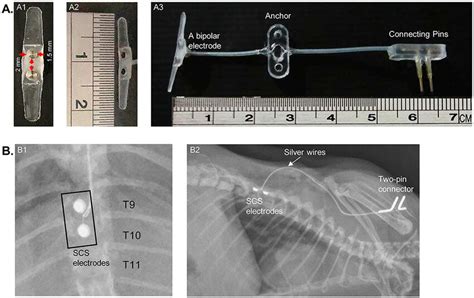 Photo And X Ray Images Illustrating The Spinal Cord Stimulation