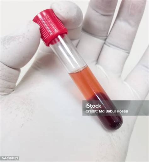 Hemólisis Humana O Plasma En Tubo De Ensayo Sobre Fondo Blanco La