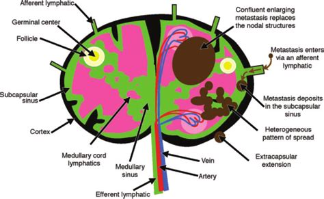 Schematic Illustrates Normal Nodal Architecture And The Growth Of