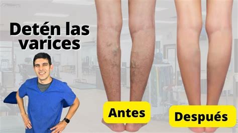Ejercicios Para Ayudar A Mejorar La Circulación Y Prevenir Las Varices