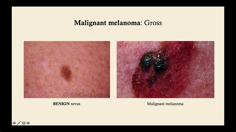 Benign Nevus Vs Melanoma
