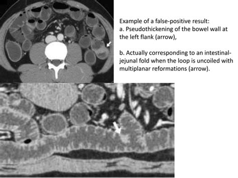 Ct Enteroclysis Pptx