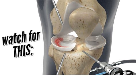 Meniscus Repair Vs Meniscectomy Youtube