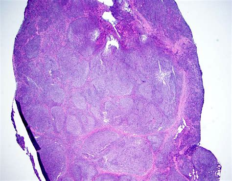 Follicular Lymphoma Pathology Outlines Follicular Lymphoma Updates