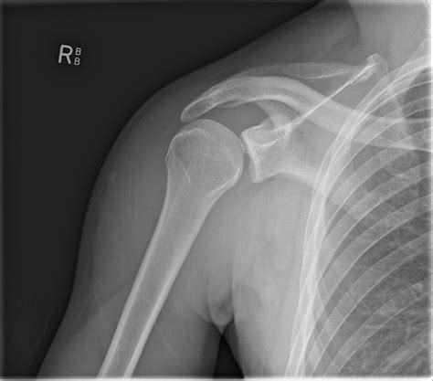 Radiopaedia Case Posterior Shoulder Dislocation Id 53737 Study 59806