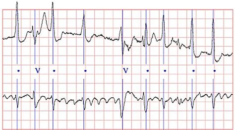Example Of The Ecg Dataset Signals [34] Download Scientific Diagram