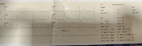 Diagnosis Presented With Hypoglycemia R Ecg