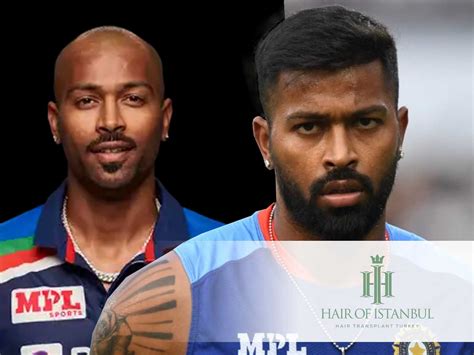 Hardik Pandya Hair Transplant Unveiling The Truth