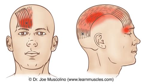 Occipitofrontalis Trigger Points Learn Muscles