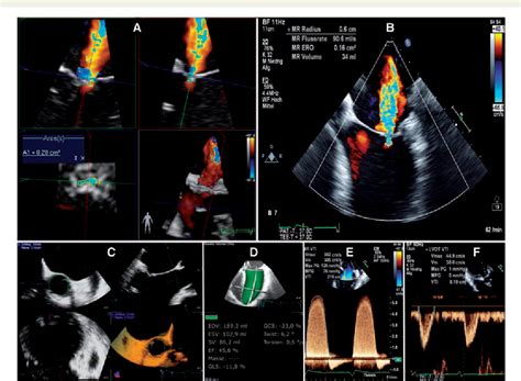 Figure 1 From Vena Contracta Area For Severity Grading In Functional And Degenerative Mitral