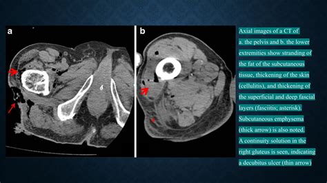 Necrotizing Soft Tissue Infection Vs Cellulitis Pptx