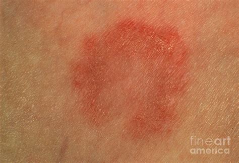 Tinea Corporis Ringworm Lesion On Skin Photograph By Science Photo