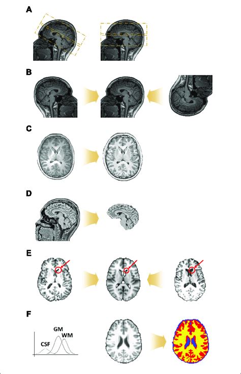 Preprocessing Steps For Volume Based T1 Weighted Structural Mri Data