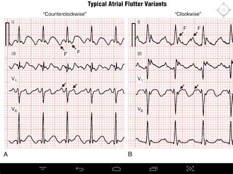 KHMER MEDECINE Atrial Flutter