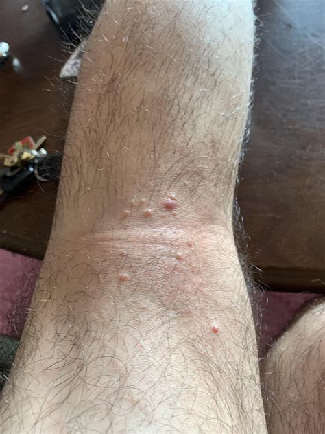 Please Help Rampant Molloscum Spread Before And After Cryotherapy What Can I Possibly Do To