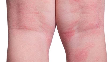 Irritant Contact Dermatitis Armpit